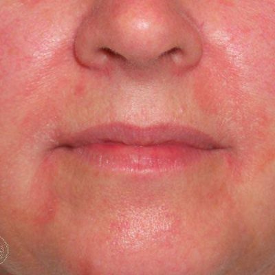 Common Skin Conditions & Skin Diseases Archive - Summit Dermatology