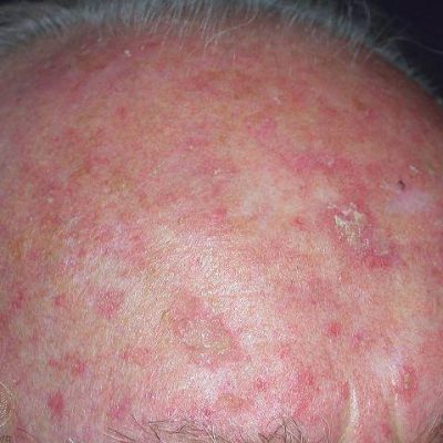Common Skin Conditions & Skin Diseases Archive - Summit Dermatology